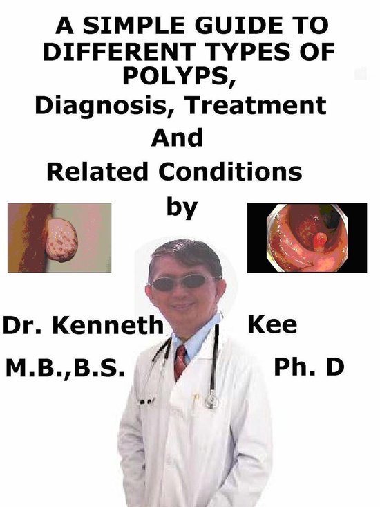A Simple Guide to Different Types of Polyps, Diagnosis, Treatment and ...