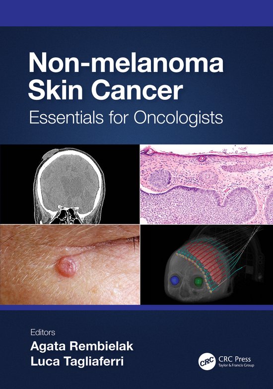 Non-melanoma Skin Cancer | 9781032103716 | Boeken | bol