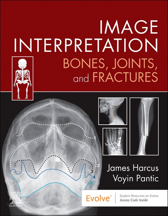 Image Interpretation: Bones, Joints, and Fractures - E-Book (ebook ...