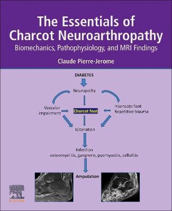 The Essentials of Charcot Neuroarthropathy: Biomechanics ...