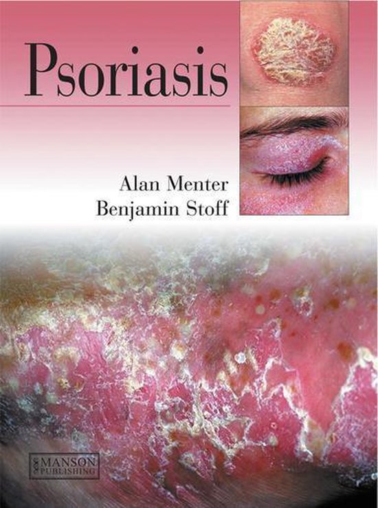 Psoriasis (ebook), Alan Menter | 9781482261585 | Boeken | bol