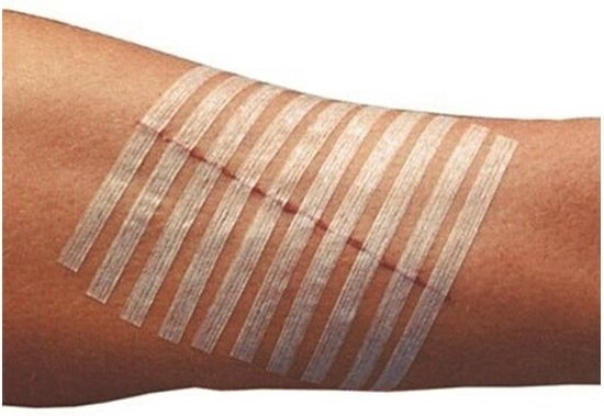 Wondhechtstrips Hechtstrips wondhechtstrips 3 mm x 75 mm 20 STUKS | bol