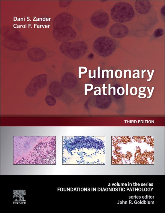 Foundations in Diagnostic Pathology - Pulmonary Pathology (ebook), John ...