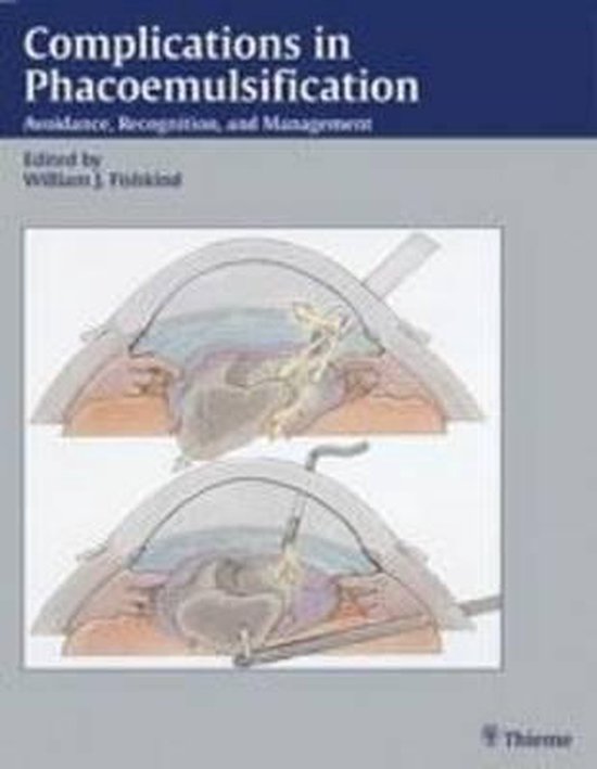 Complications in Phacoemulsification, William J Fishkind | 9783131246813 | Boeken | bol.com