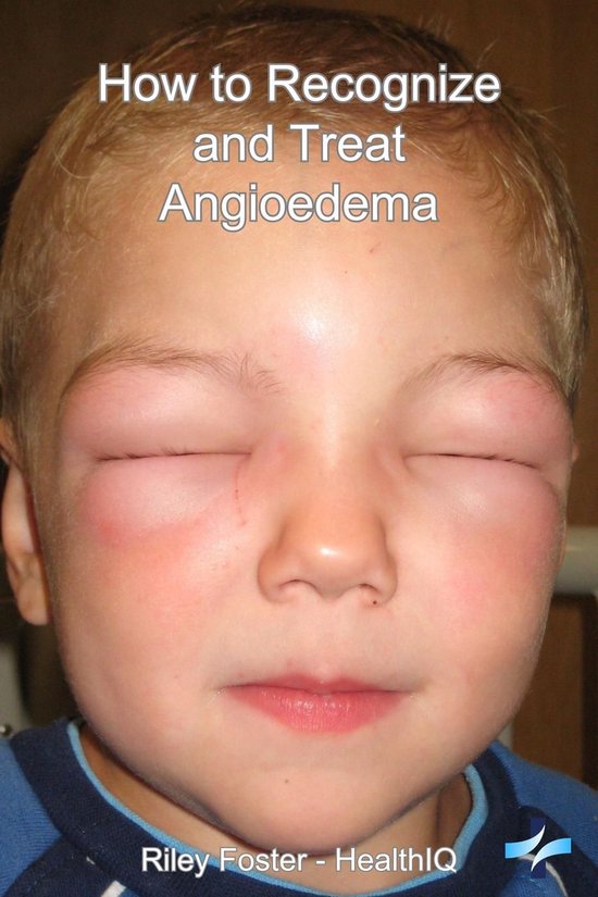 How to Recognize and Treat Angioedema (ebook), Riley Foster ...