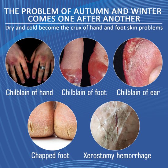 Winterhandcrème, droge handen en voeten, schilferende scheur, anti ...