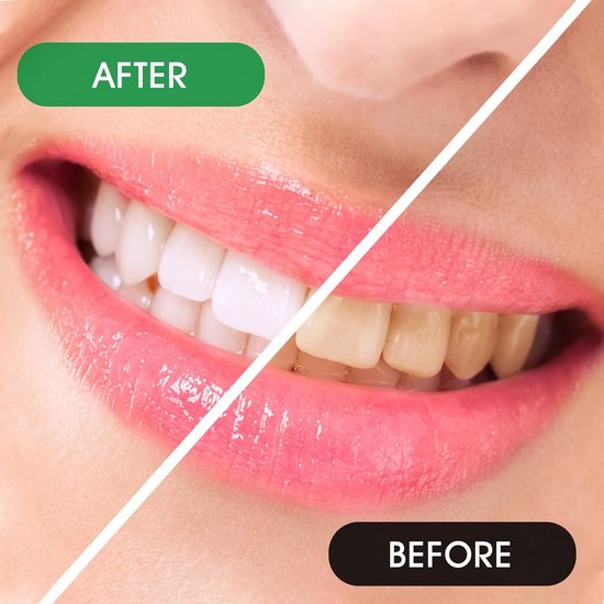 25 Stuks Interdentale Ragers Set in 5 Maten voor Tussen Tanden en ...