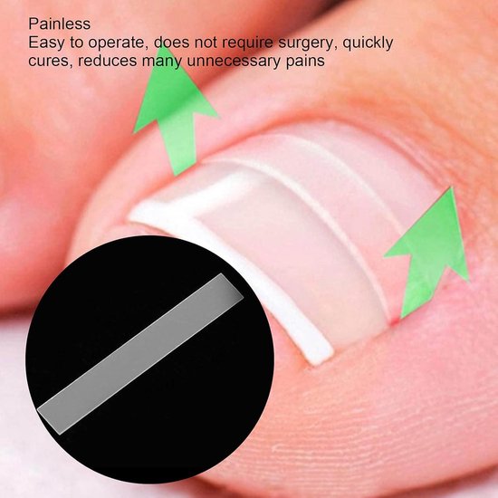 Ingegroeide Teennagel Corrector Strips - Behandeling voor Paronychia ...