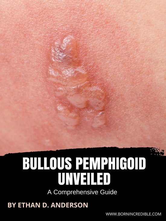 Bullous Pemphigoid Unveiled: A Comprehensive Guide (ebook), Ethan D ...