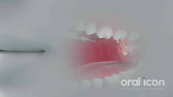 Oral Icon Amandelstenen Verwijderaar - Voor frisse adem - Veilig ...