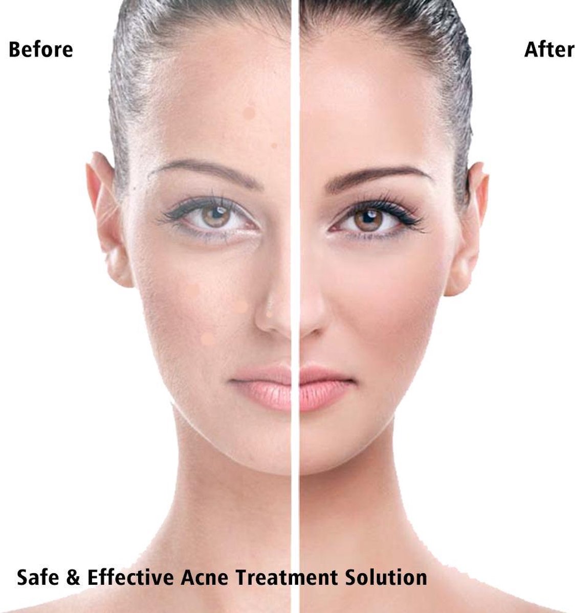 SMILEPLUS - Acne Spot Patches - Pimple Patch - Acne stickers - Puisten ...