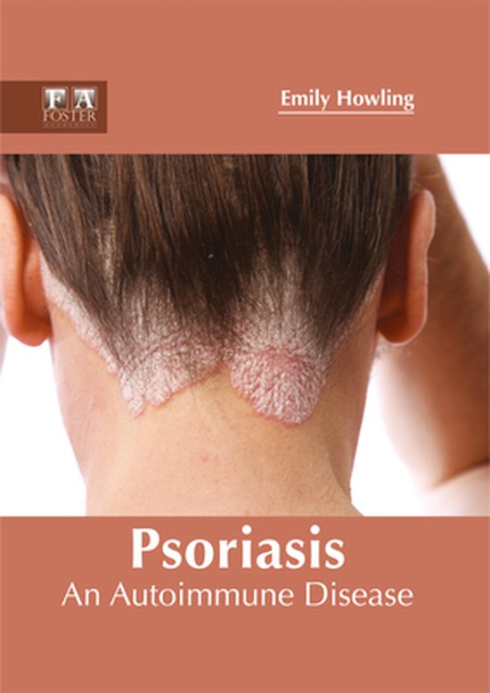 Psoriasis: An Autoimmune Disease | 9781632424754 | Boeken | bol
