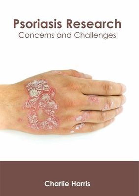 Psoriasis Research: Concerns and Challenges | 9781632426222 | Boeken | bol