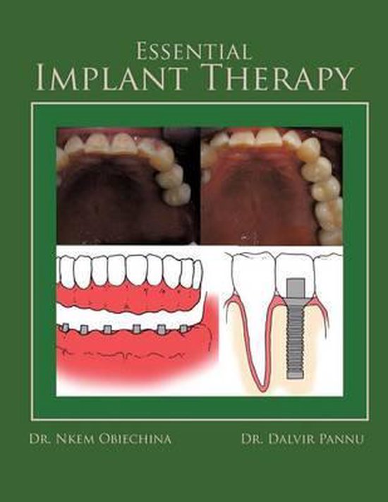 Essential Implant Therapy | 9781463420413 | Dr. Nkem Obiechina | Boeken | bol.com