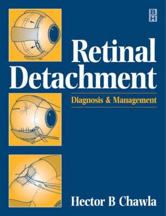 Retinal Detachment, Hector Bryson Chawla | 9780750639804 | Boeken | bol