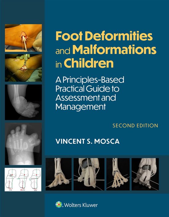 Foot Deformities and Malformations in Children (ebook), Vincent Mosca ...