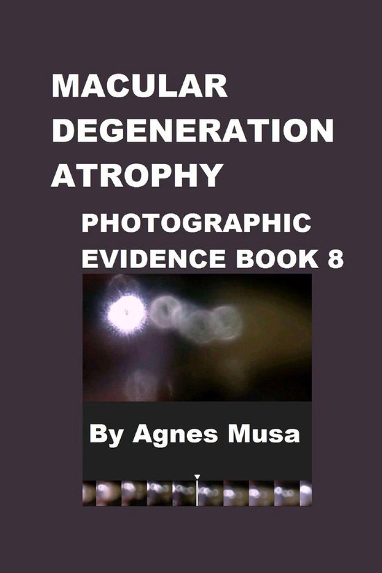 Macular Degeneration Atrophy, Photographic Evidence Series of Books 8 ...