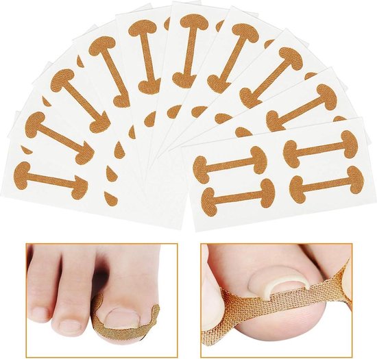 Ingegroeide Teennagel Correctie Beugel - Ademend & Elastisch - 40 Stuks ...